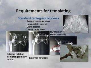 Templating of total hip replacement (THR) | PPTX
