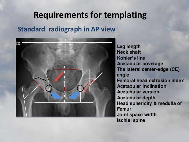 Templating of total hip replacement (THR)
