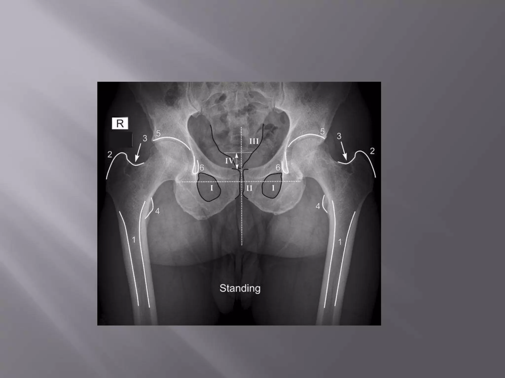 Templating X-rays in THR | PPTX