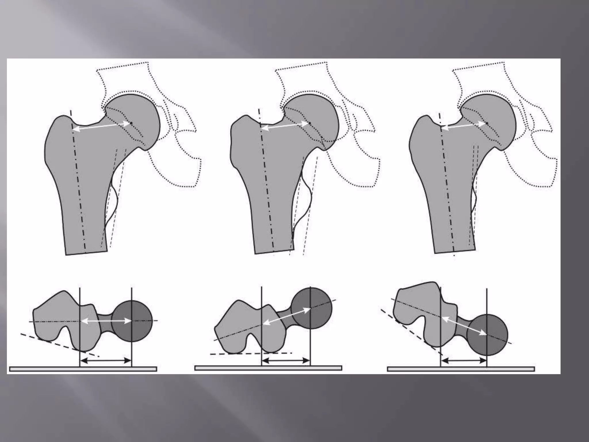 Templating X-rays in THR | PPTX