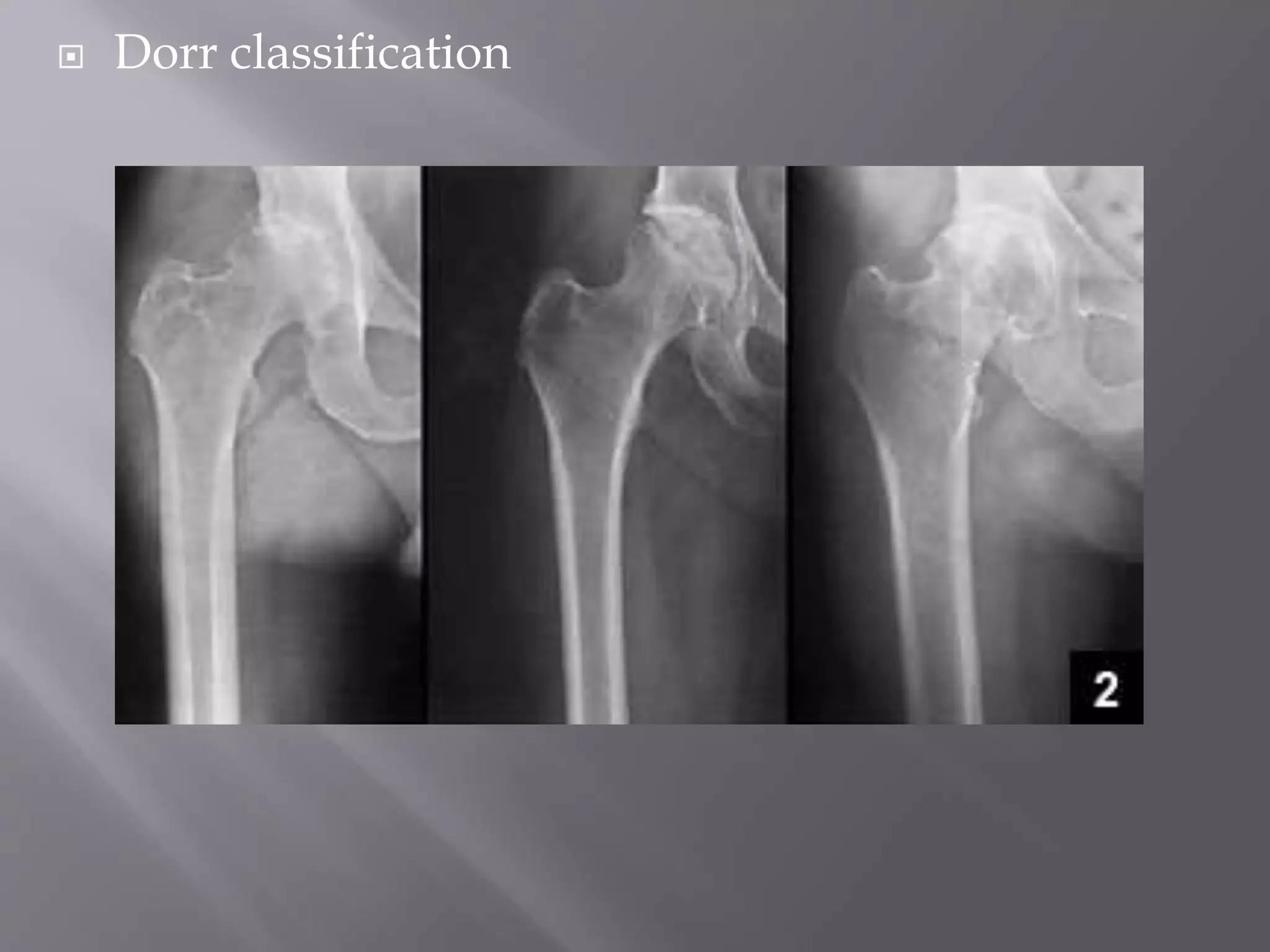 Templating X-rays in THR | PPTX