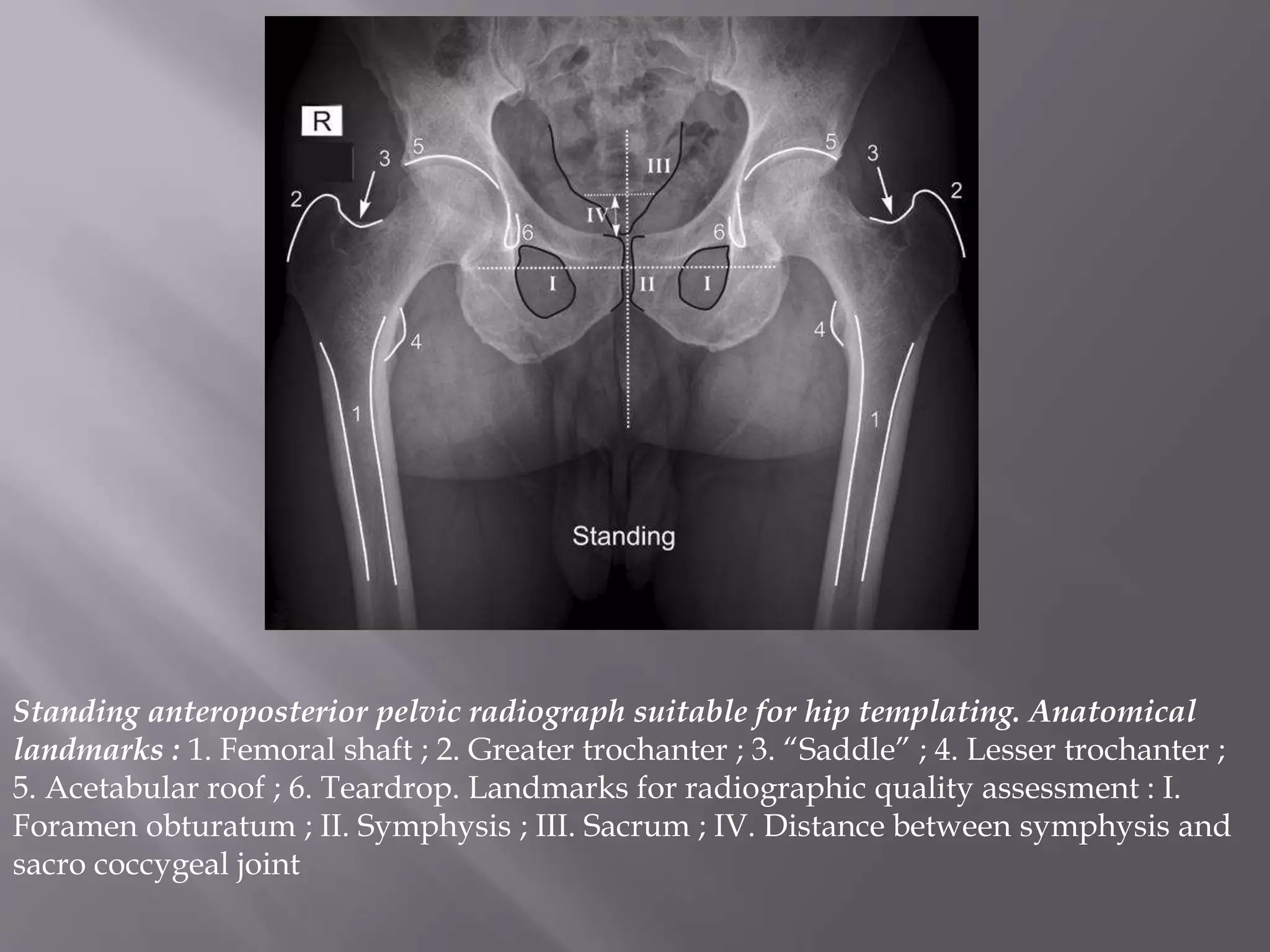 Templating X-rays in THR | PPTX