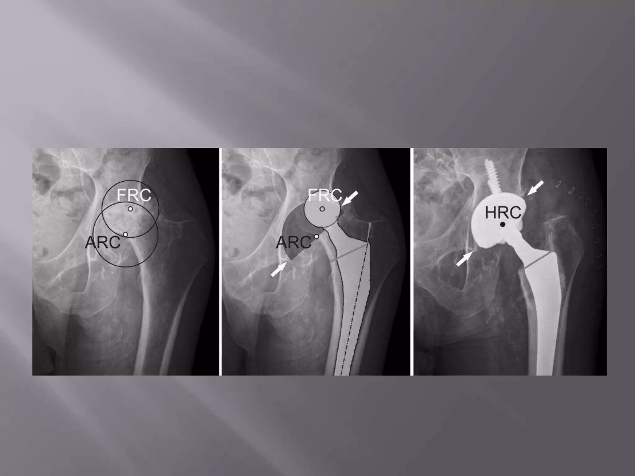 Templating X-rays in THR | PPTX