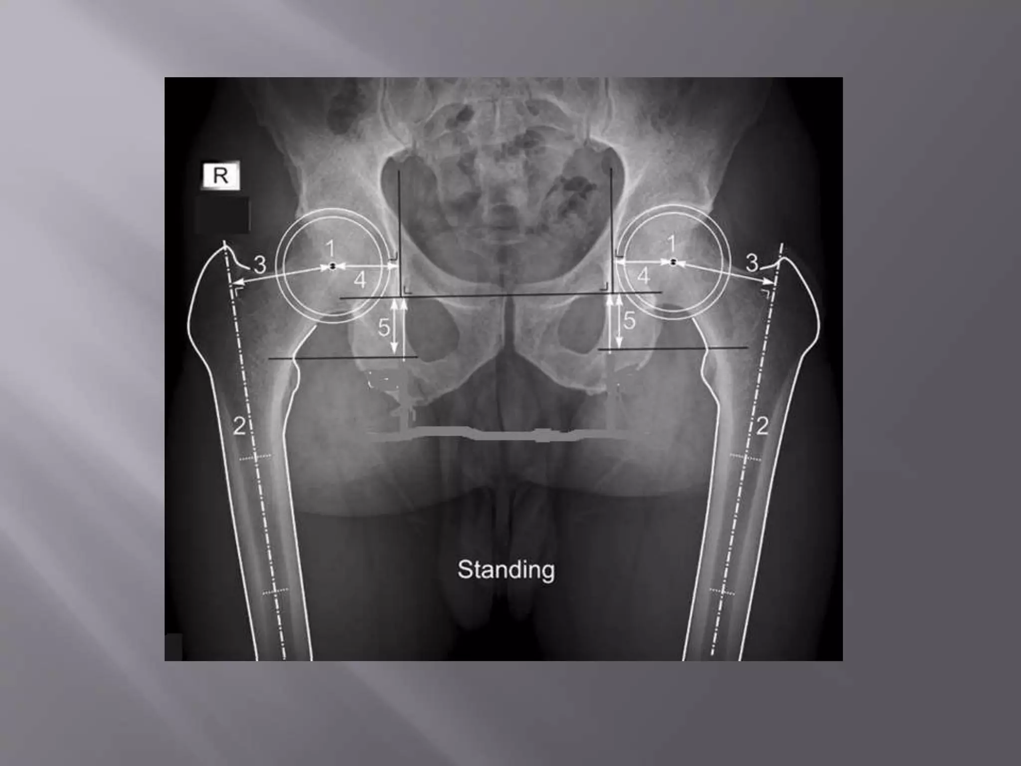Templating X-rays in THR | PPTX