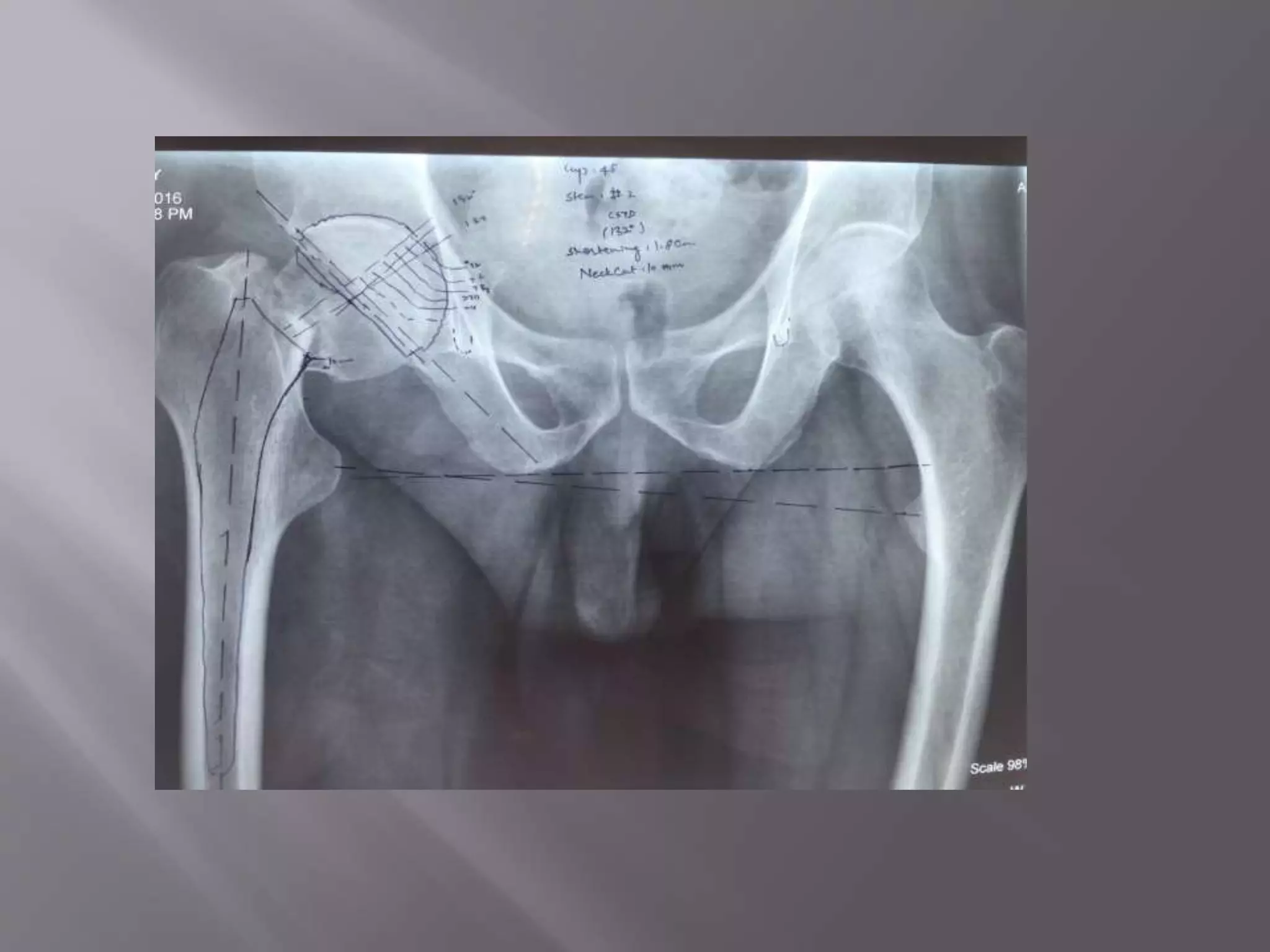 Templating X-rays in THR | PPTX