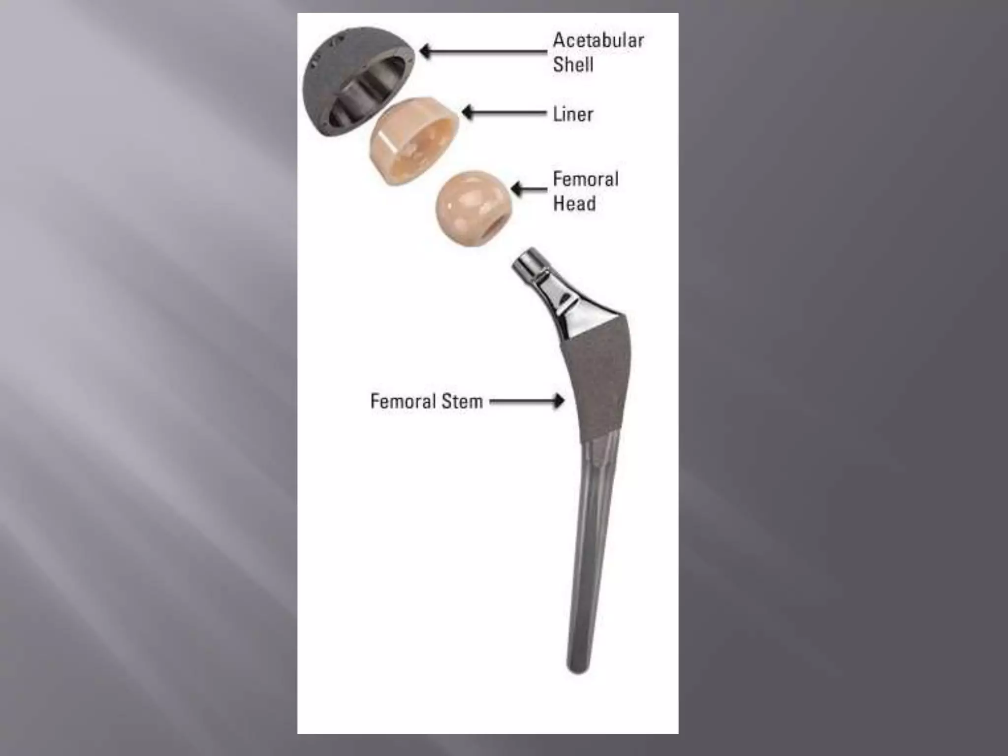 Templating X-rays in THR | PPTX