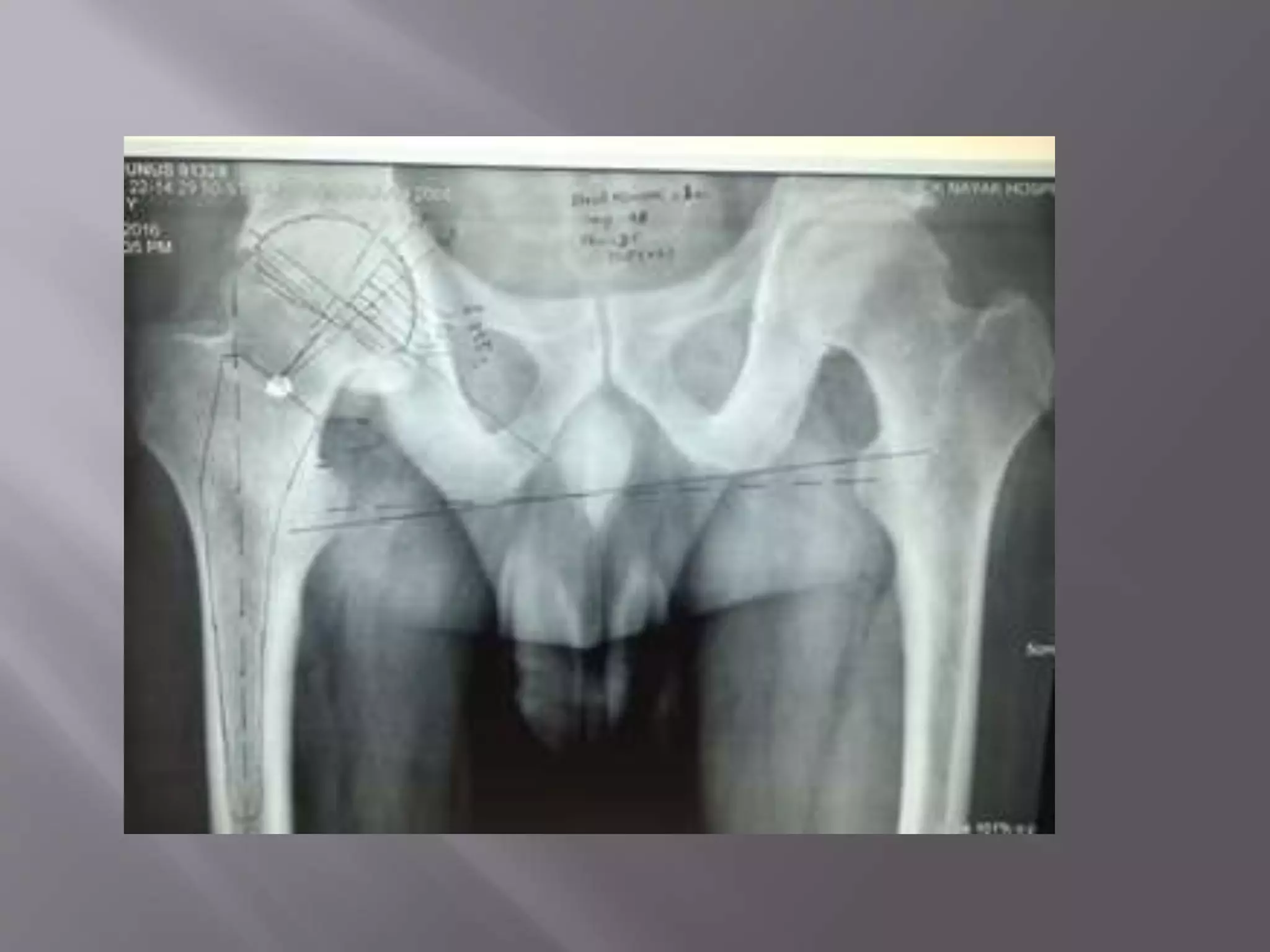 Templating X-rays in THR | PPTX