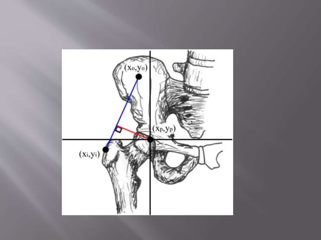 Templating X-rays in THR | PPTX | Death, Injury, or Military Conflict ...