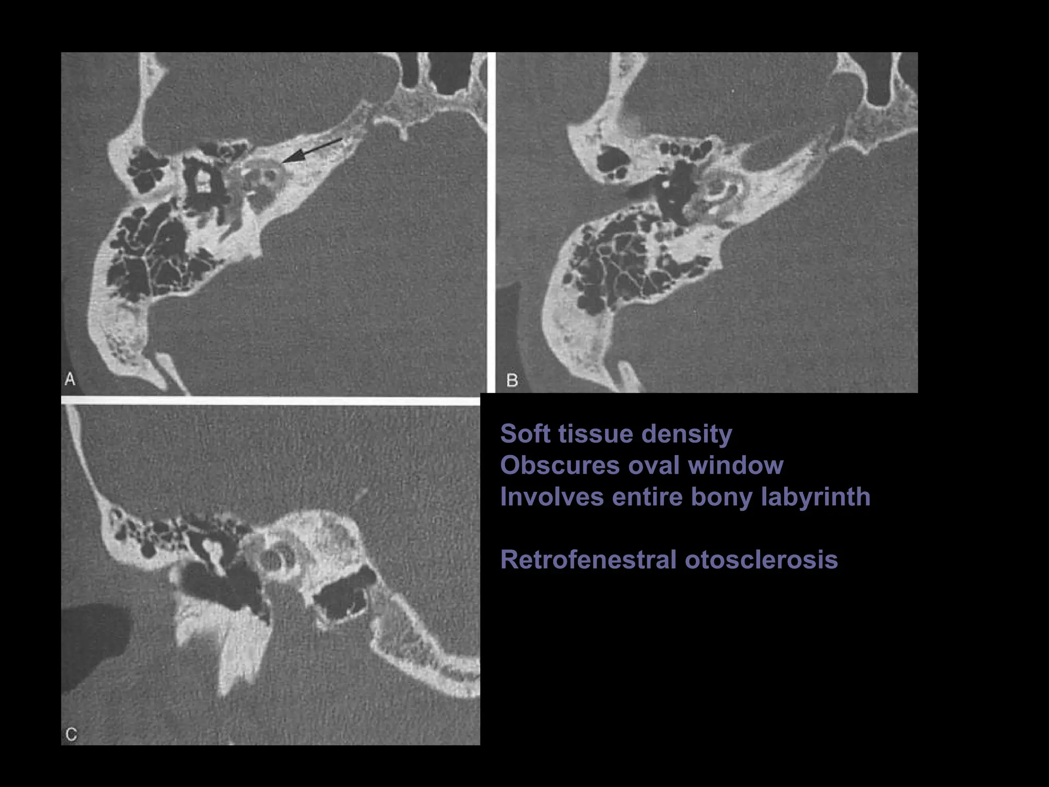 Temporal-bone-lesions-slides -0 40915.ppt