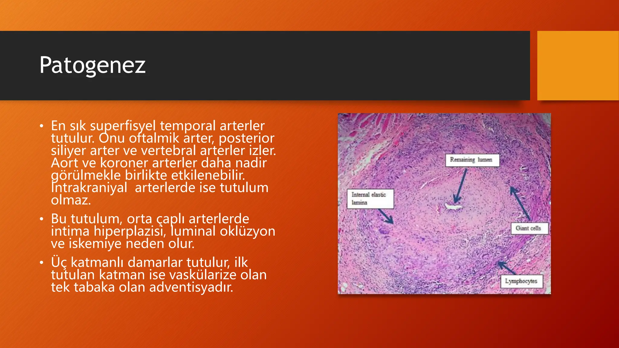 temporal arterit SUNUM TANIM PATOGENEZ TEDAVİ | PPTX