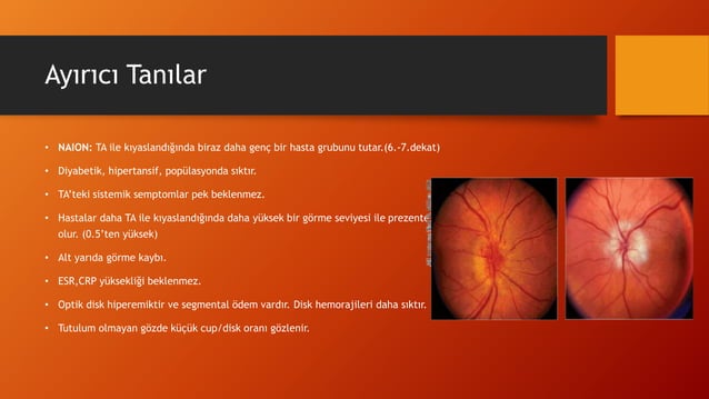 temporal arterit SUNUM TANIM PATOGENEZ TEDAVİ | PPTX