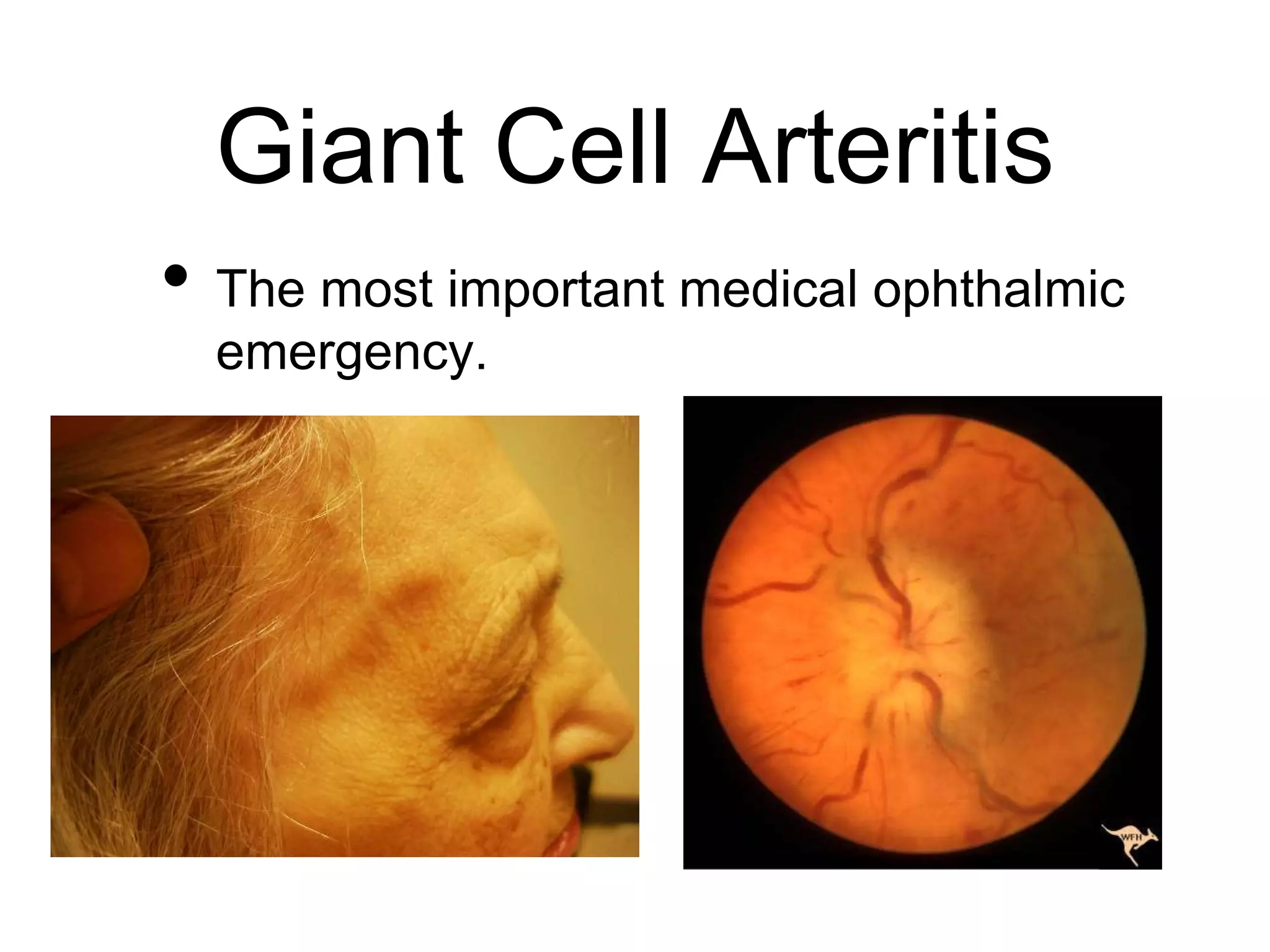 Temporal artery biopsy | PPTX