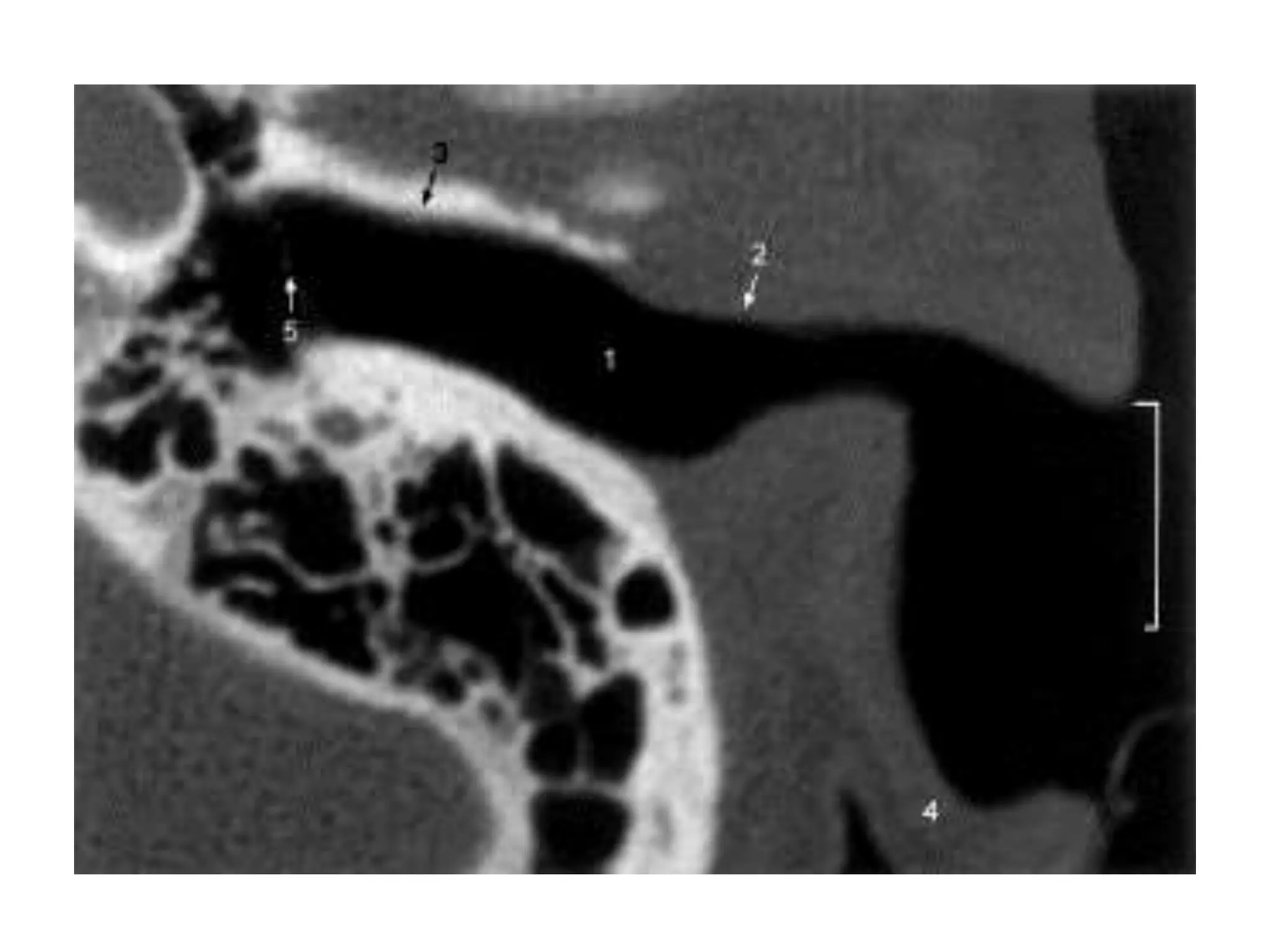 Temporal bone radiology | PPTX