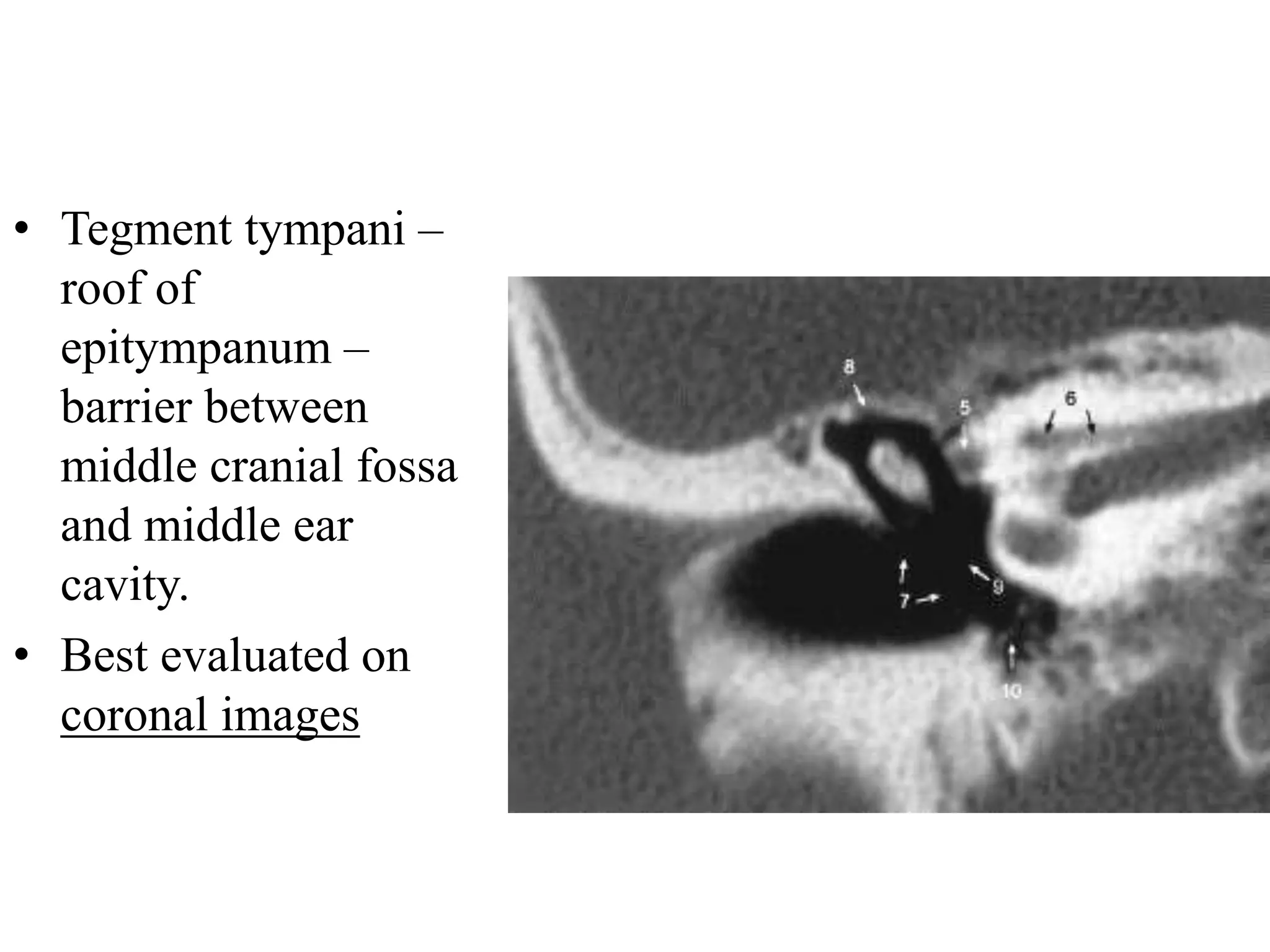 Temporal bone radiology | PPTX