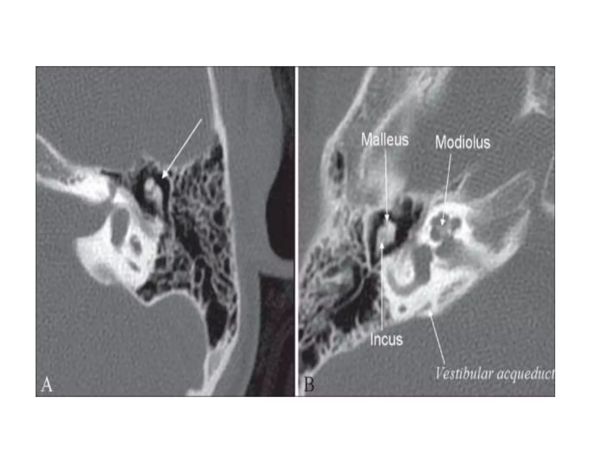 Temporal bone radiology | PPTX