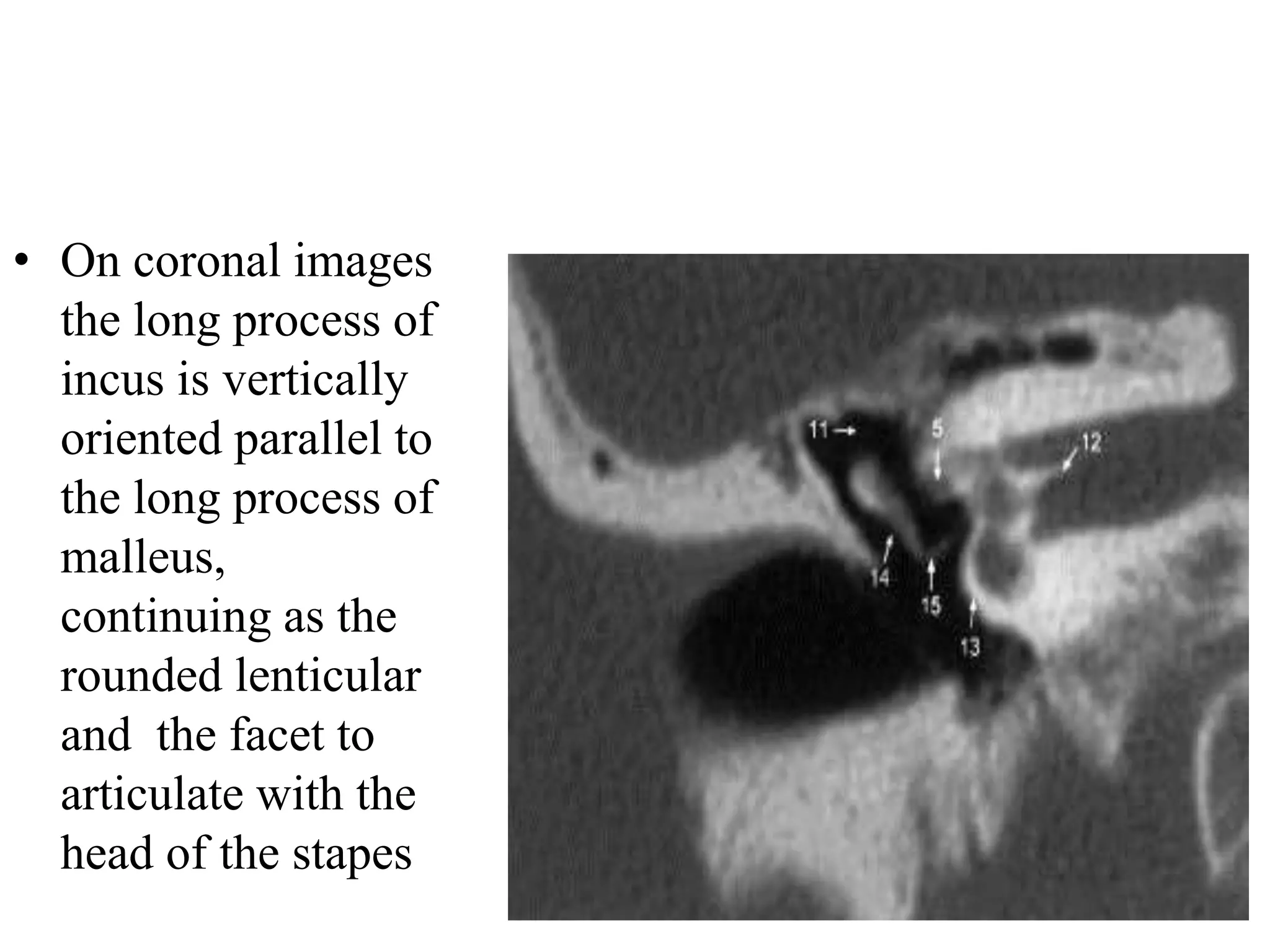 Temporal bone radiology | PPTX