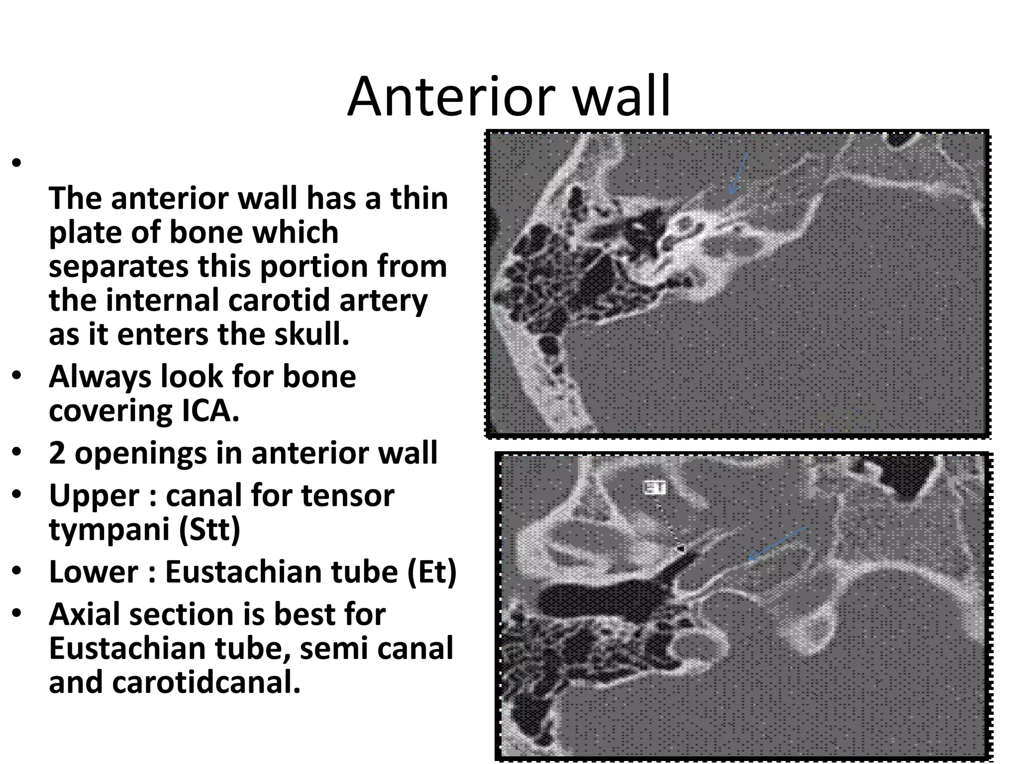 Temporal bone radiology | PPTX