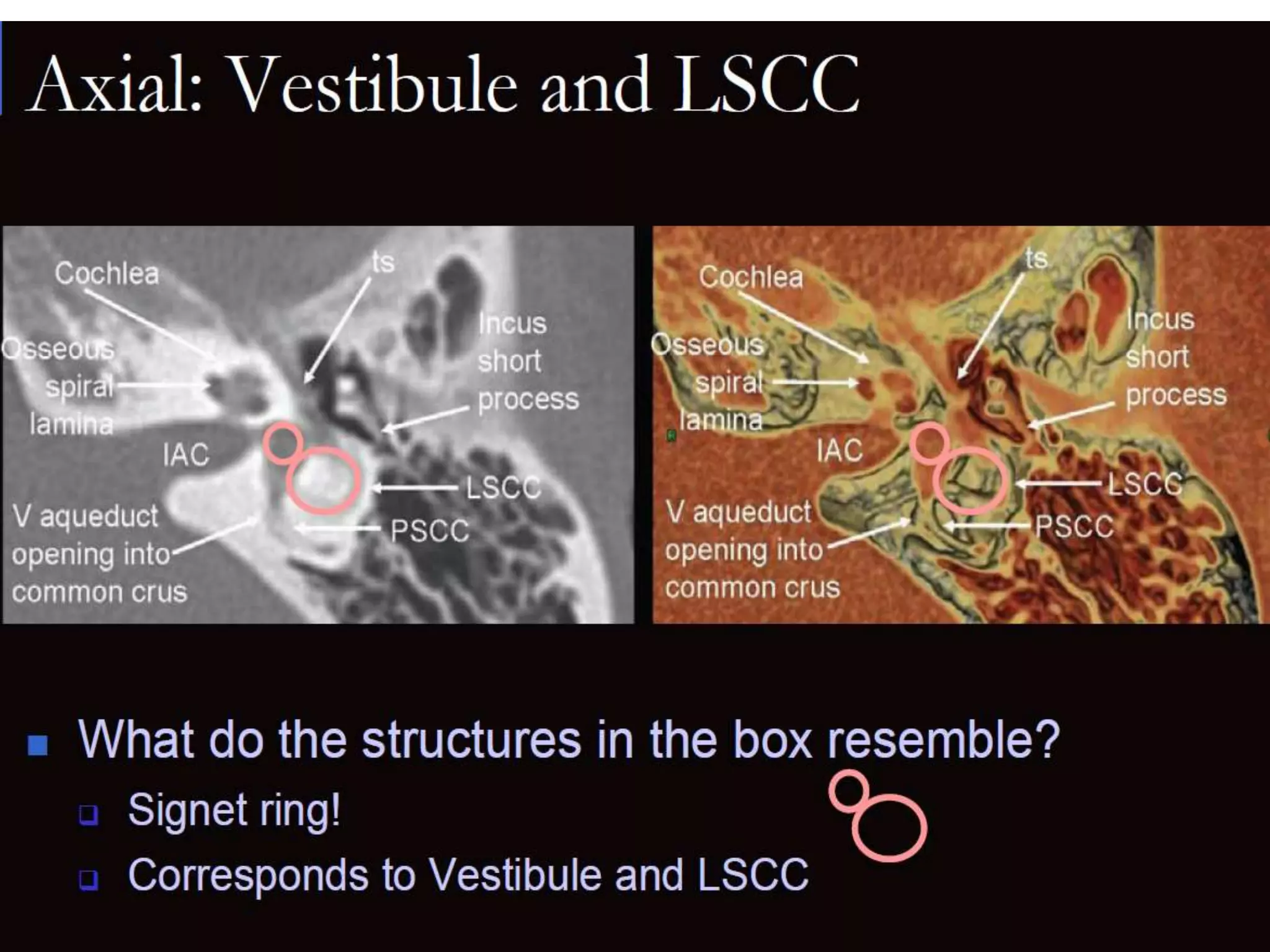 Temporal bone radiology | PPTX