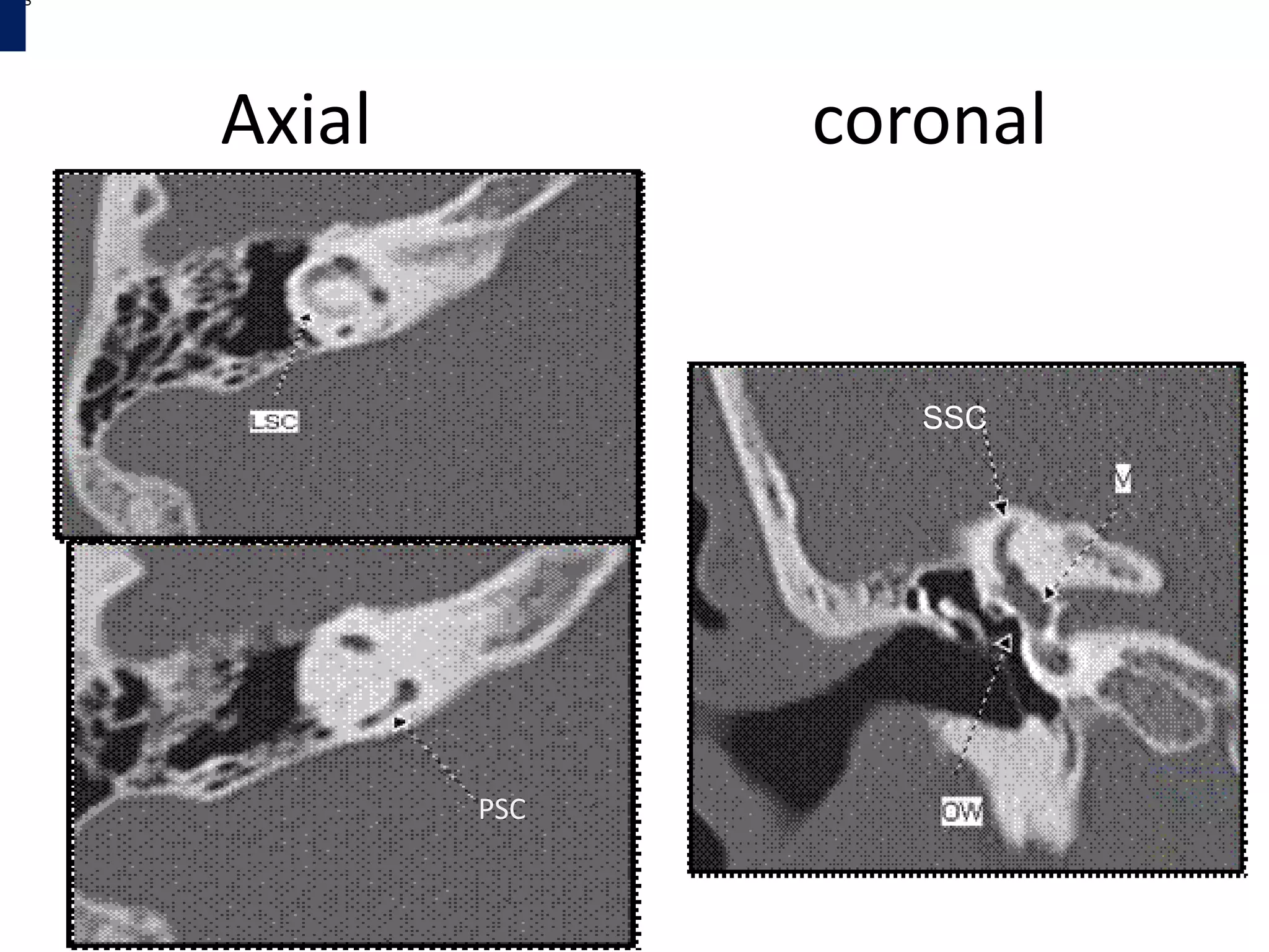 Temporal bone radiology | PPTX