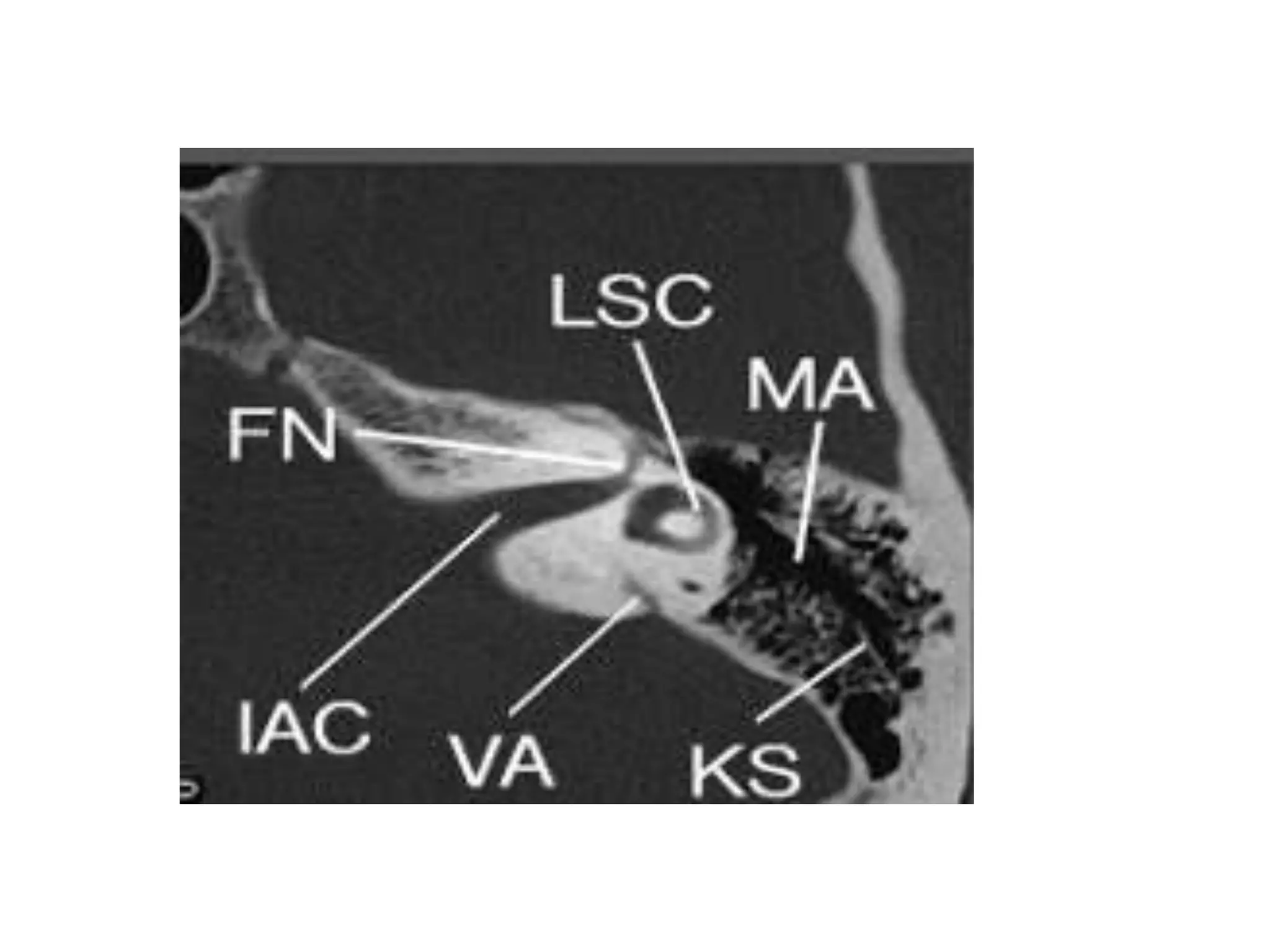 Temporal bone radiology | PPTX