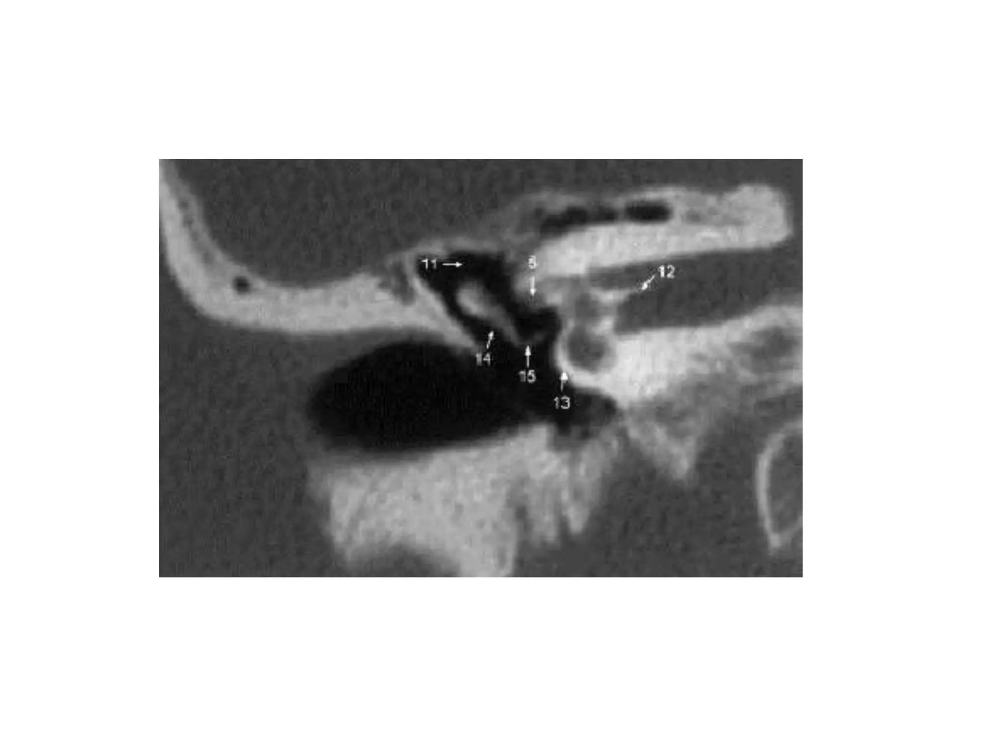 Temporal bone radiology | PPTX