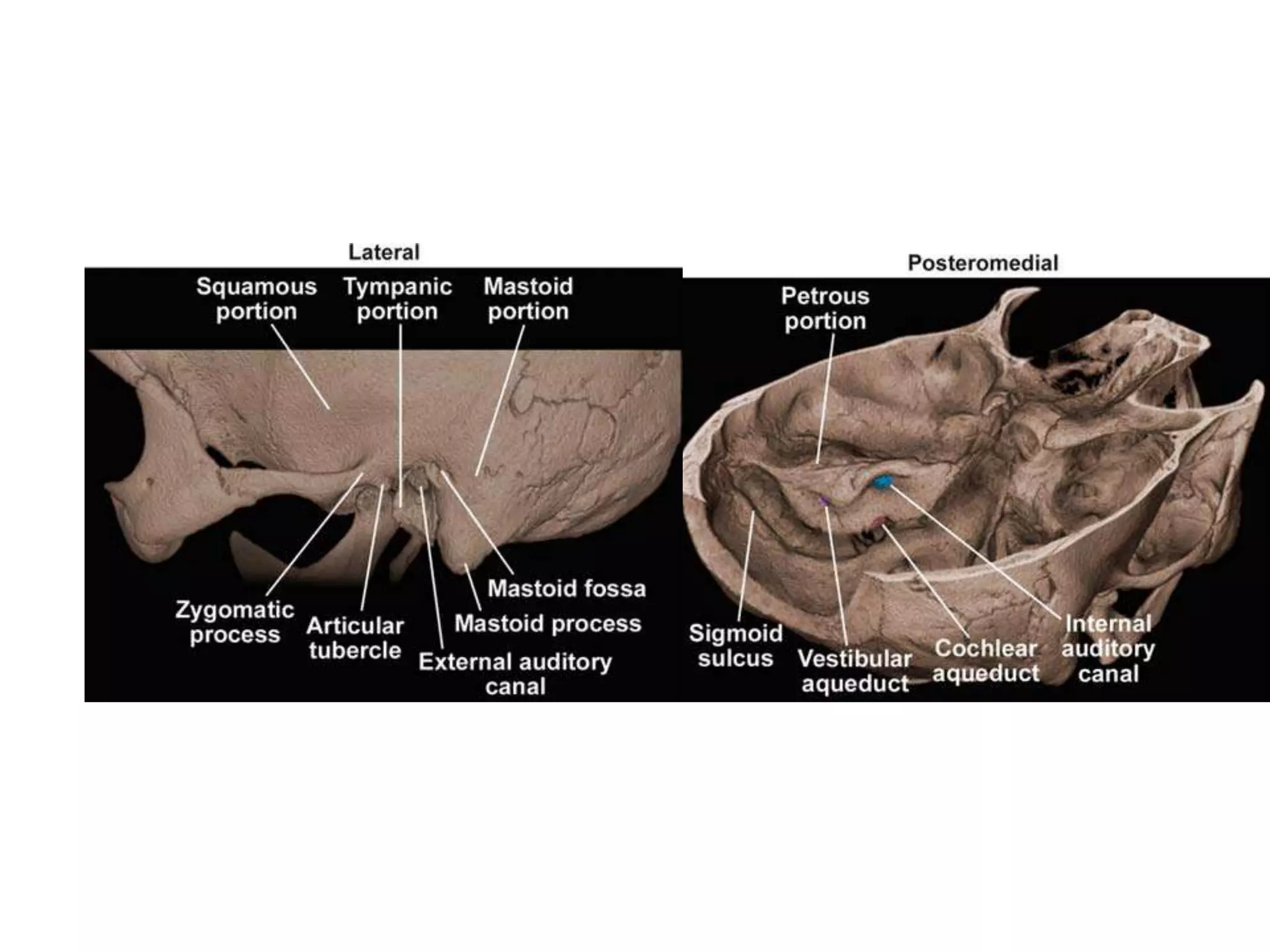 Temporal bone radiology | PPTX