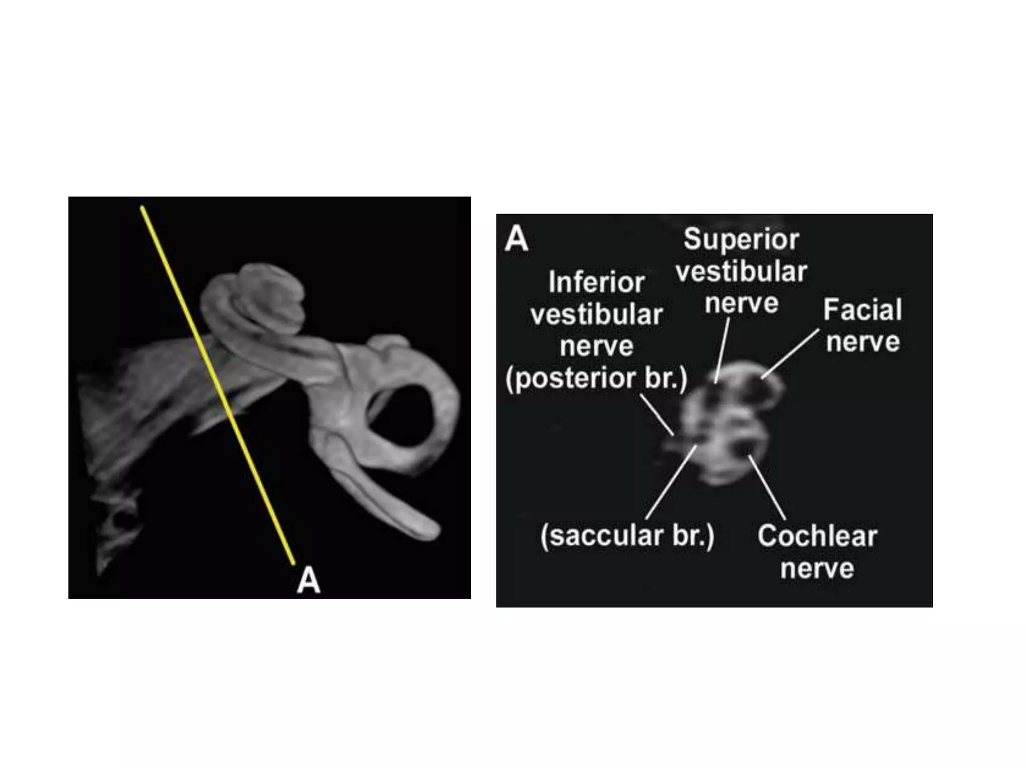 Temporal bone radiology | PPTX