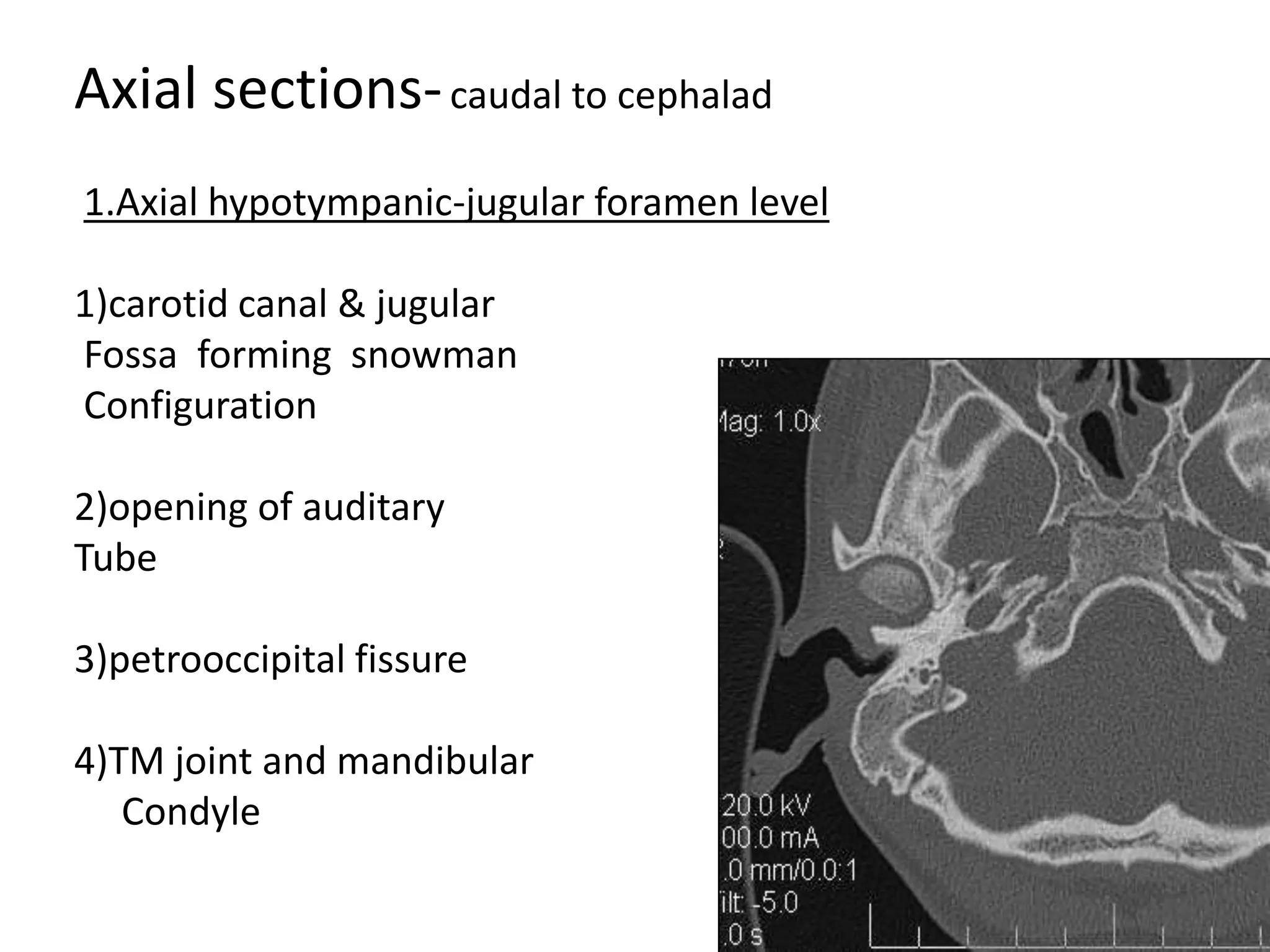 Temporal bone radiology | PPTX