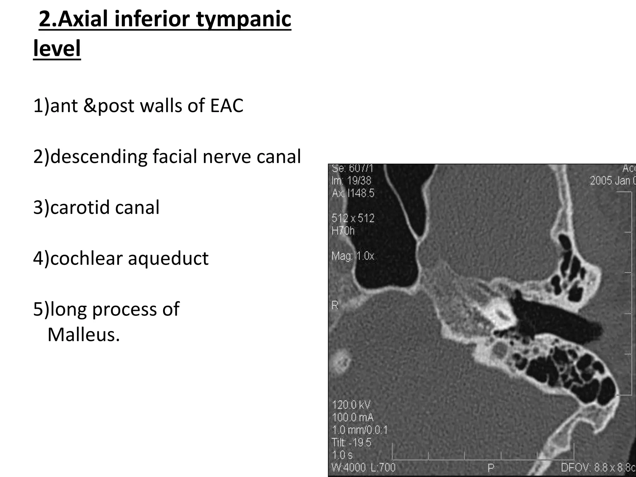 Temporal bone radiology | PPTX