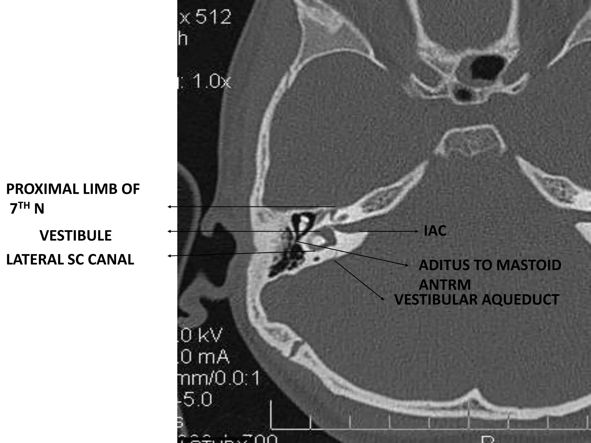 Temporal bone radiology | PPTX