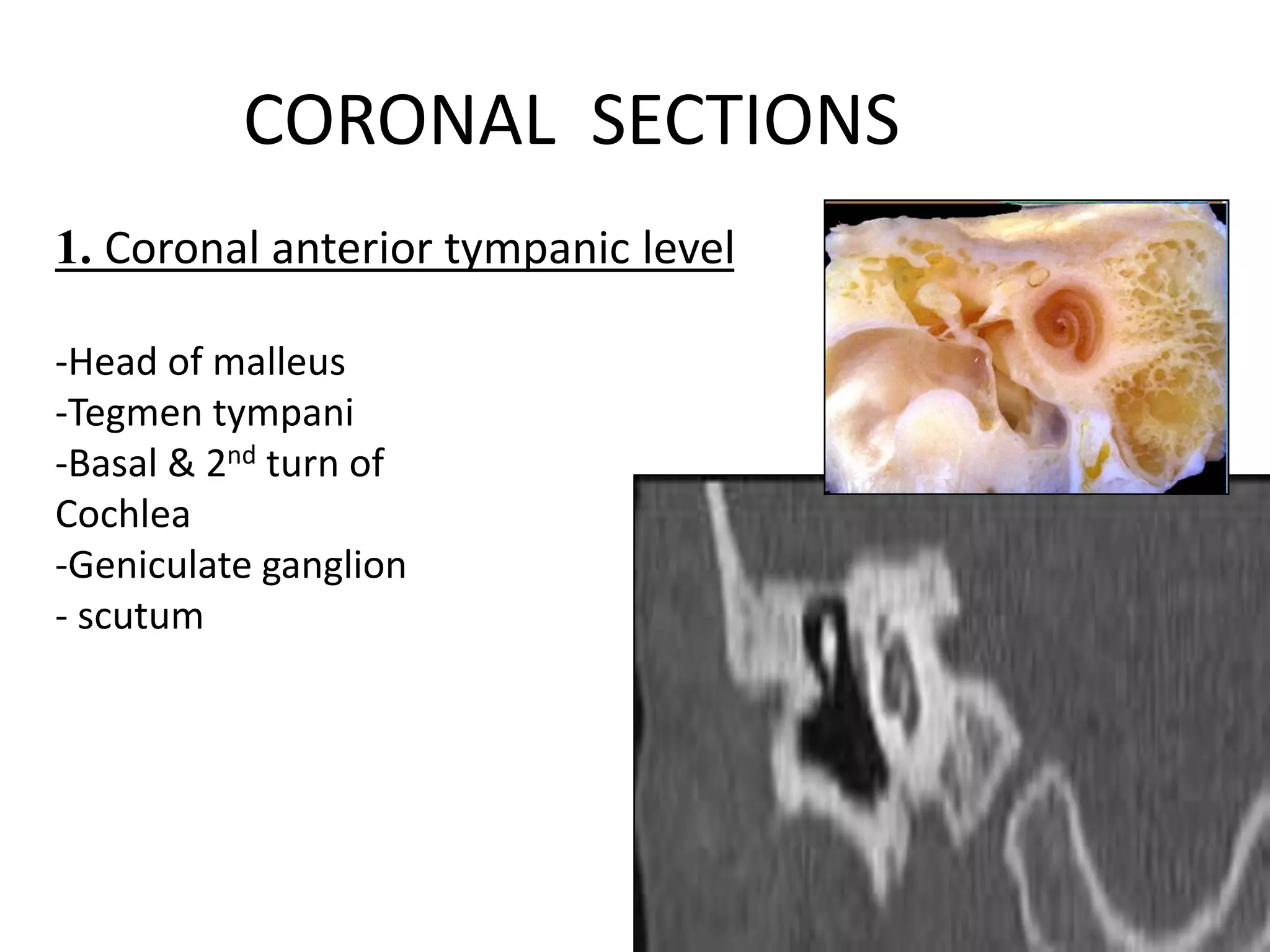 Temporal bone radiology | PPTX