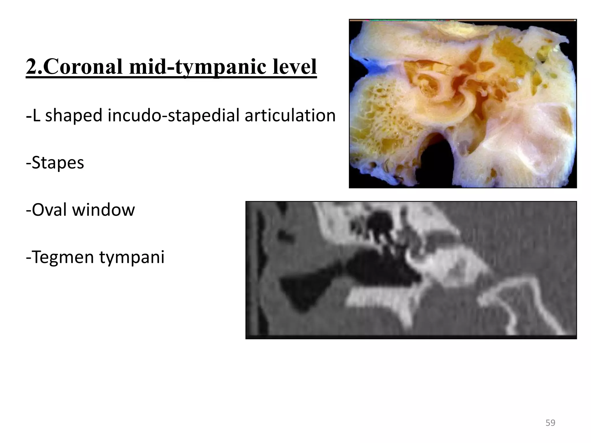 Temporal bone radiology | PPTX
