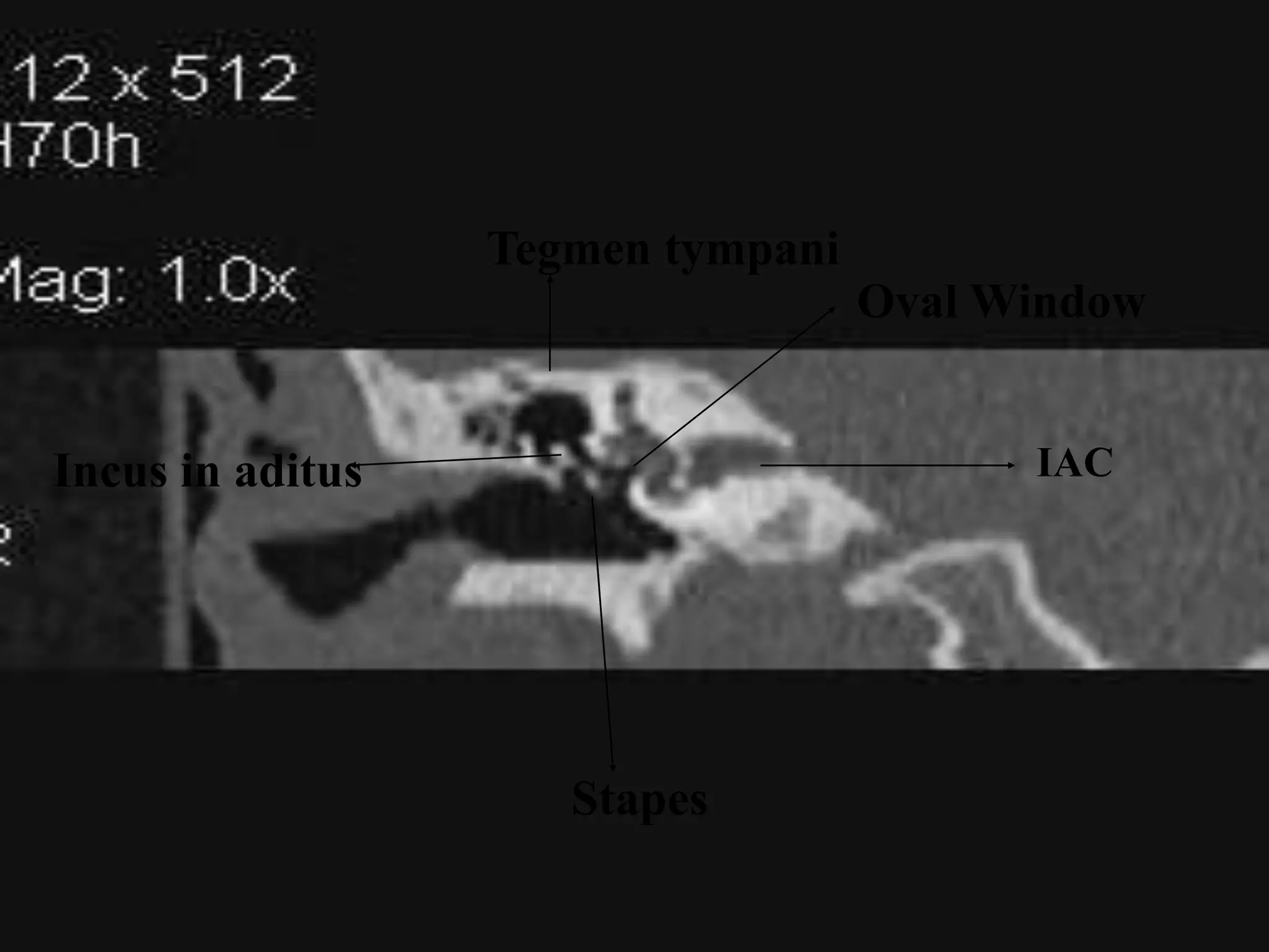 Temporal bone radiology | PPTX