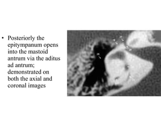 Temporal bone radiology | PPTX