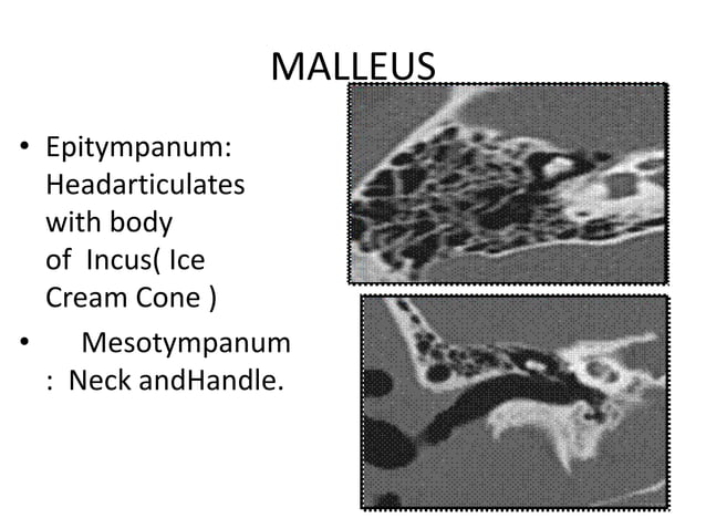 Temporal bone radiology | PPTX | Ear, Nose and Throat Conditions ...