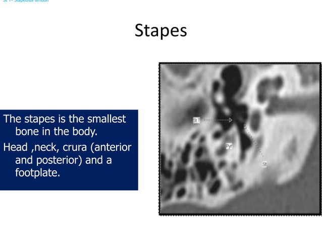Temporal bone radiology | PPTX | Ear, Nose and Throat Conditions ...