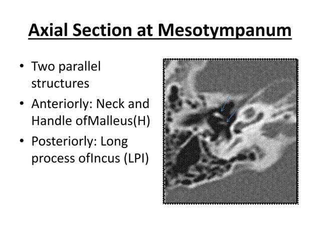 Temporal bone radiology | PPTX | Ear, Nose and Throat Conditions ...