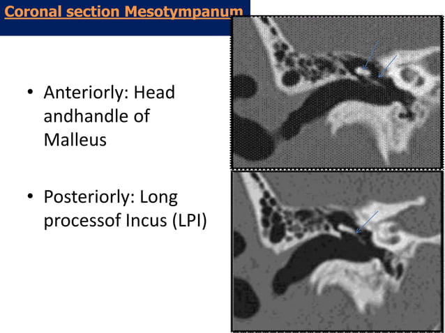 Temporal bone radiology | PPTX | Ear, Nose and Throat Conditions ...