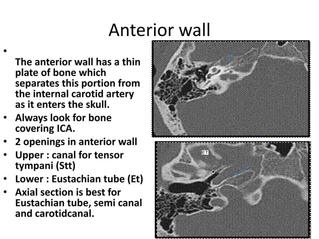 Temporal bone radiology | PPTX | Ear, Nose and Throat Conditions ...