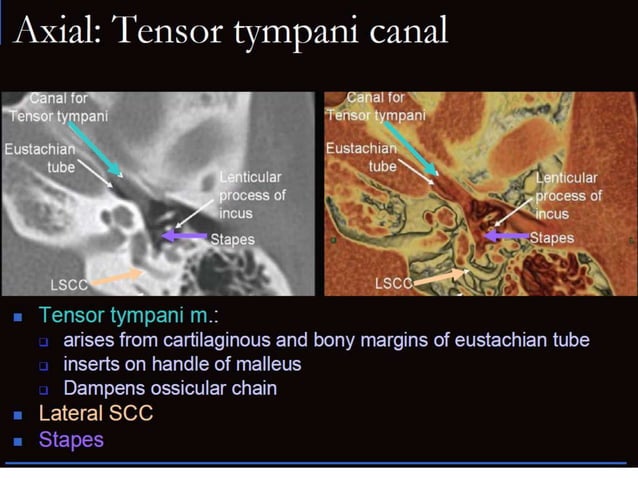 Temporal bone radiology | PPTX | Ear, Nose and Throat Conditions ...