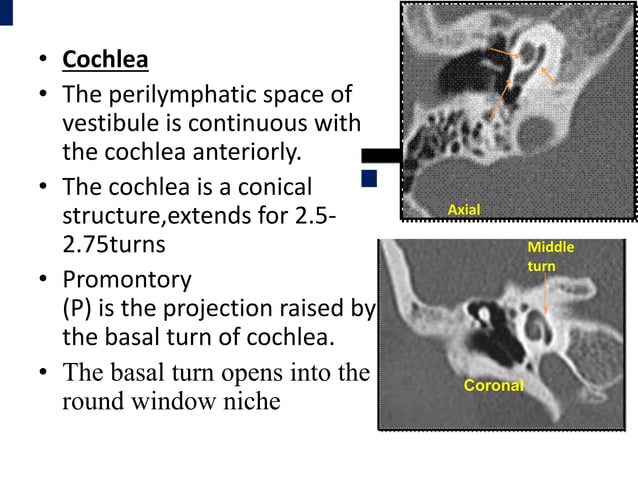 Temporal bone radiology | PPTX | Ear, Nose and Throat Conditions ...