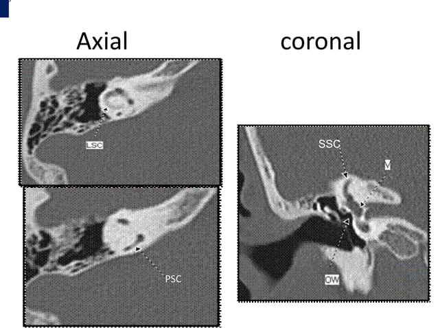 Temporal bone radiology | PPTX | Ear, Nose and Throat Conditions ...