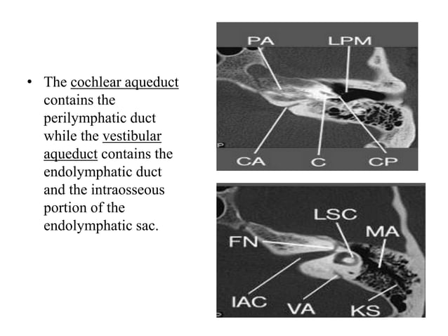 Temporal bone radiology | PPTX | Ear, Nose and Throat Conditions ...