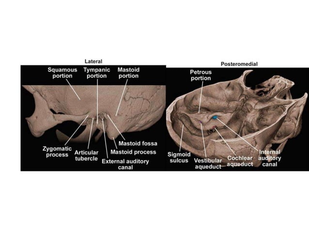 Temporal bone radiology | PPTX | Ear, Nose and Throat Conditions ...