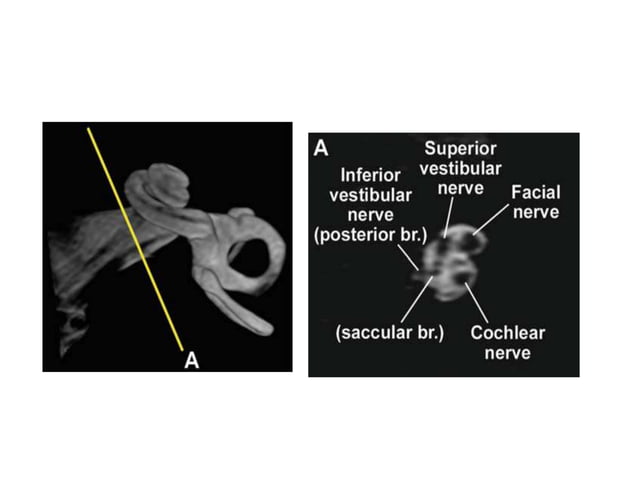 Temporal bone radiology | PPTX | Ear, Nose and Throat Conditions ...