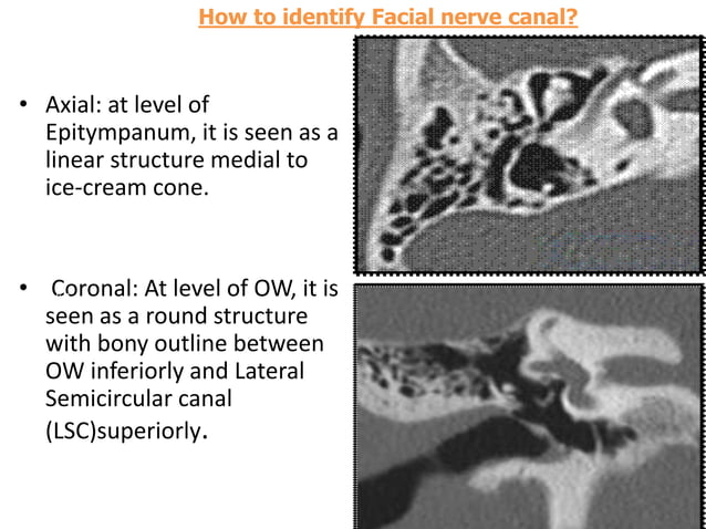 Temporal bone radiology | PPTX | Ear, Nose and Throat Conditions ...