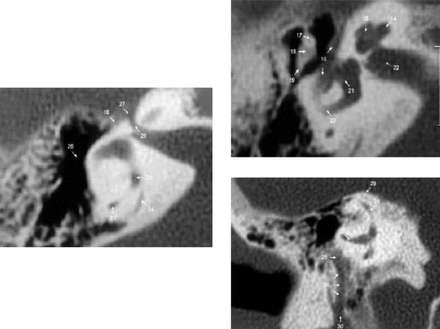 Temporal bone radiology | PPTX | Ear, Nose and Throat Conditions ...