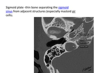 Temporal bone radiology | PPTX