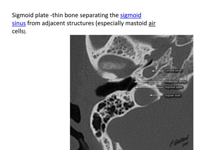 Temporal bone radiology | PPTX | Ear, Nose and Throat Conditions ...