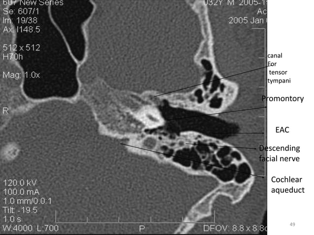 Temporal bone radiology | PPTX | Ear, Nose and Throat Conditions ...
